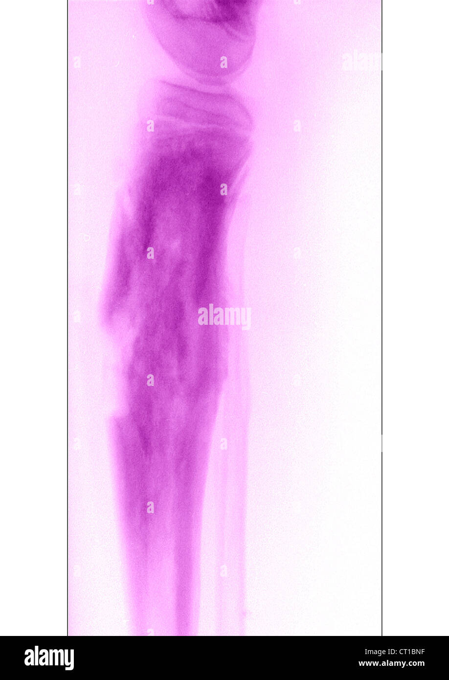 FRACTURED TIBIA, X-RAY Stock Photo - Alamy