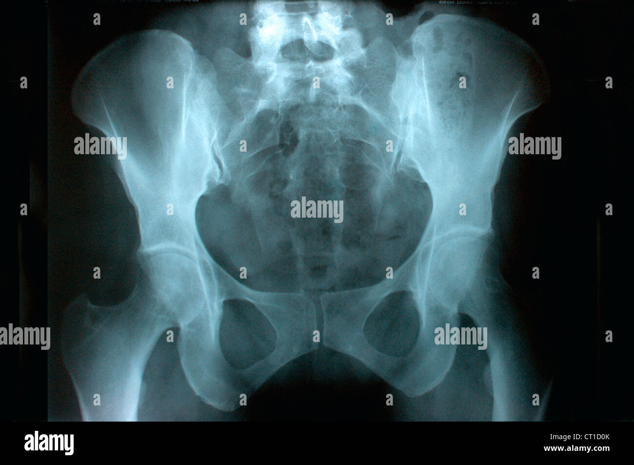 HIP, X-RAY RESULT Stock Photo - Alamy