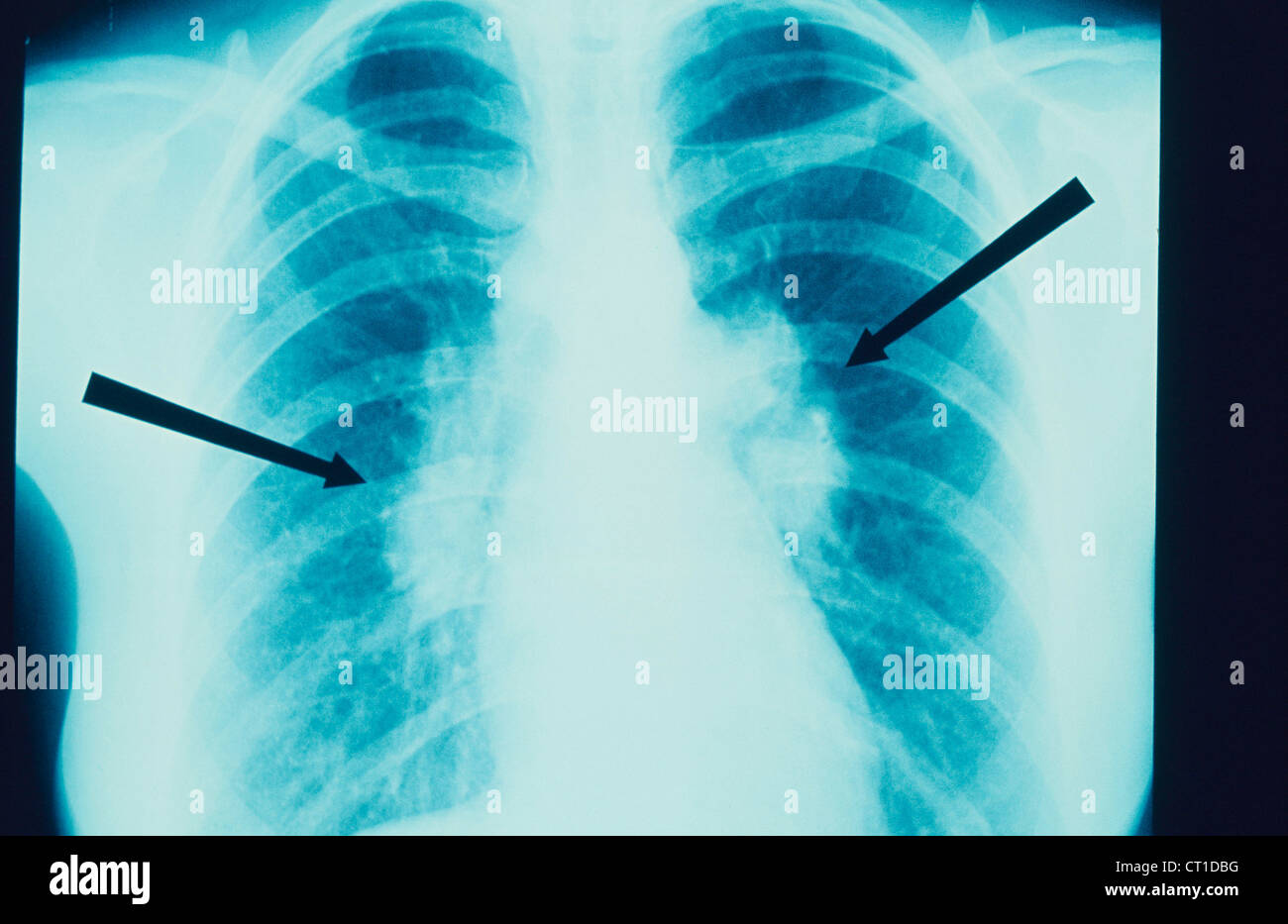 Lung sarcoidosis hi-res stock photography and images - Alamy