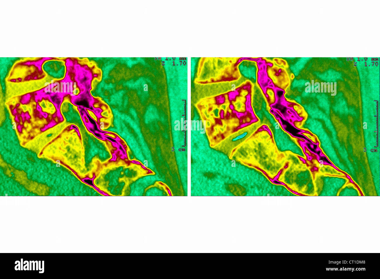 Pagets disease of bone hi-res stock photography and images - Alamy