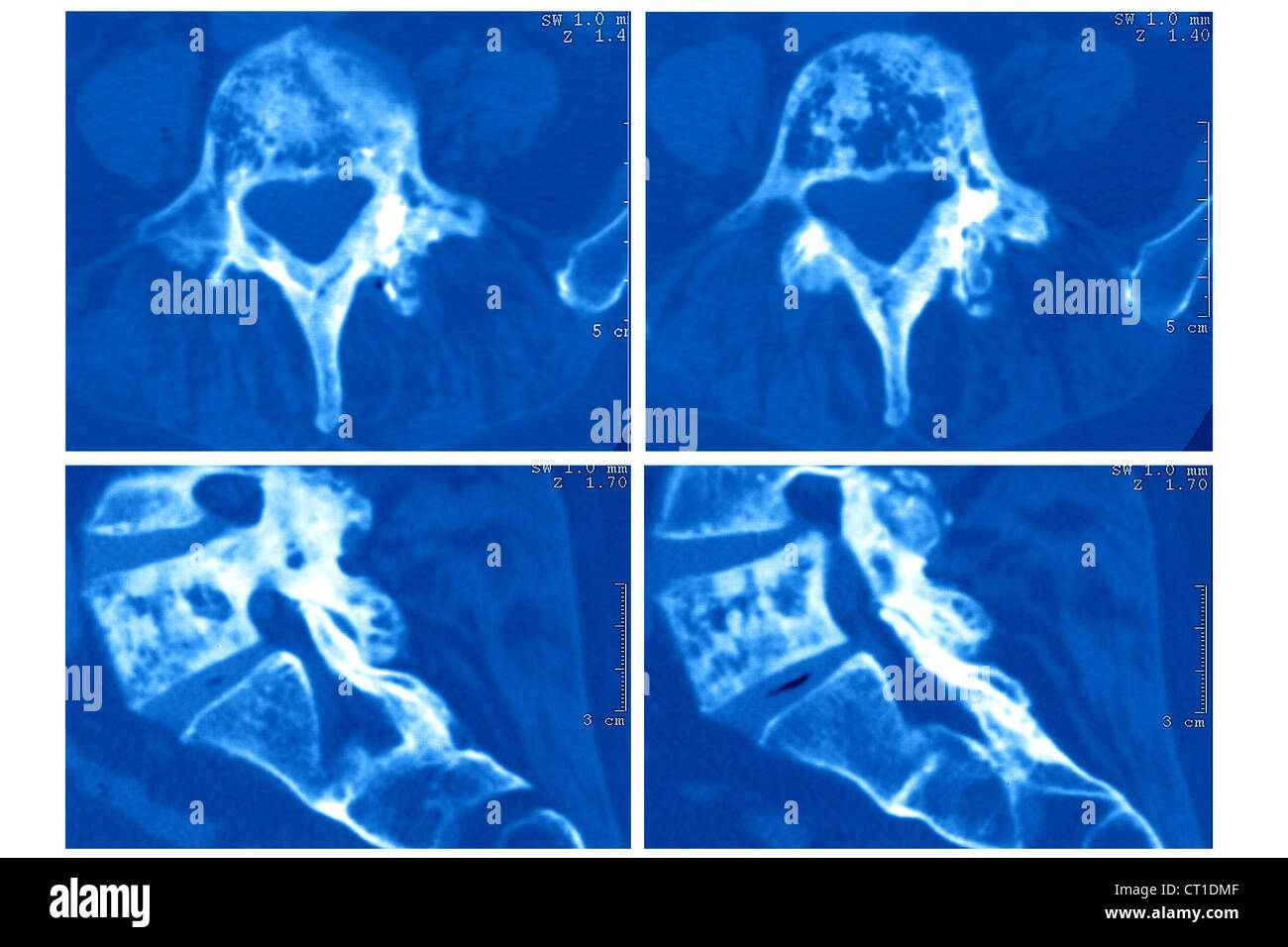 Pagets disease hi-res stock photography and images - Alamy