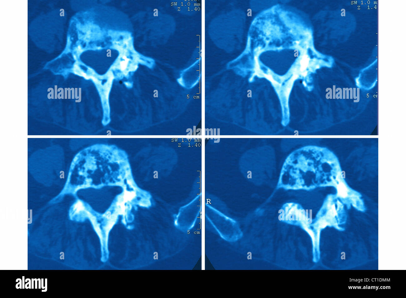 Pagets disease hi-res stock photography and images - Alamy