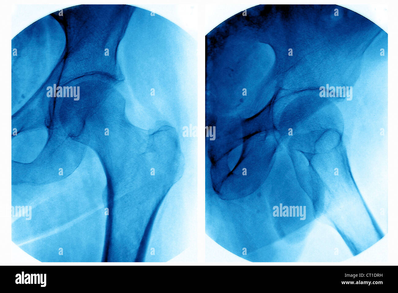 HIP, X-RAY RESULT Stock Photo - Alamy