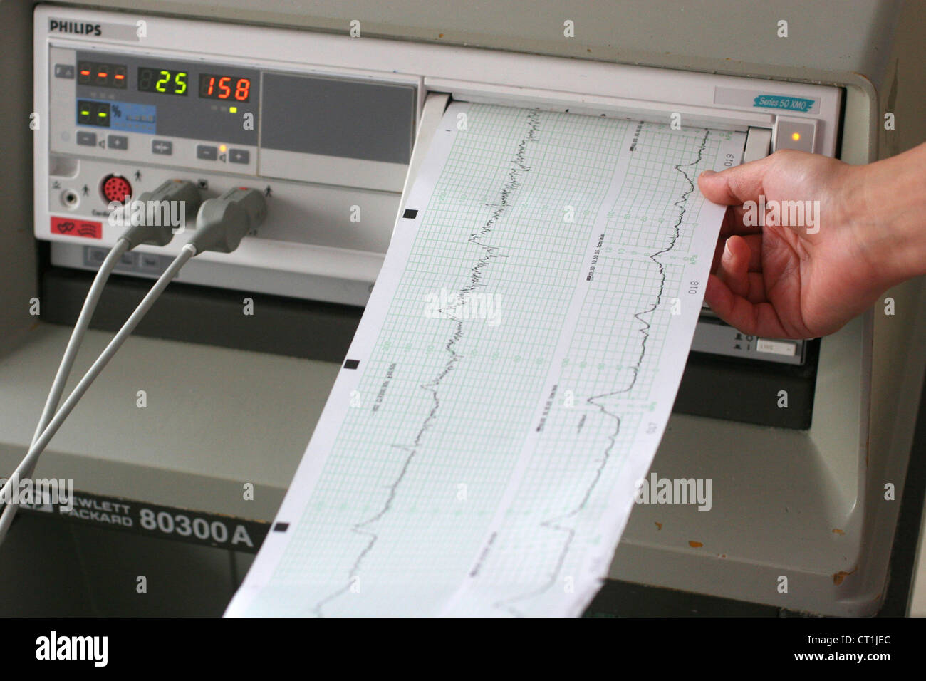 Cardiotocography Stock Photos & Cardiotocography Stock Images - Alamy