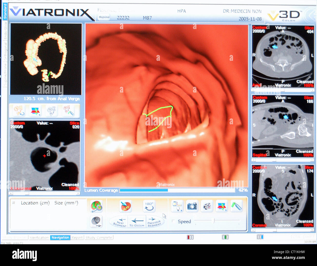 Virtual colonoscopy hi-res stock photography and images - Alamy