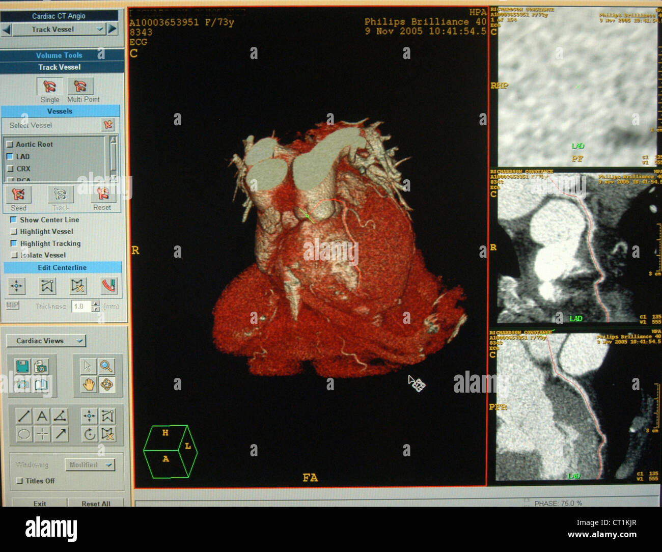 HEART, 3D SCAN Stock Photo - Alamy