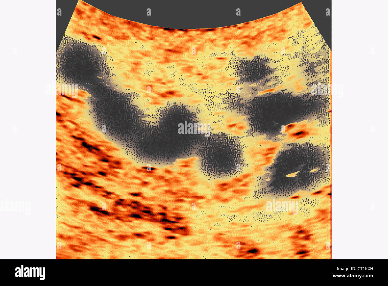 Varicocele hi-res stock photography and images - Alamy