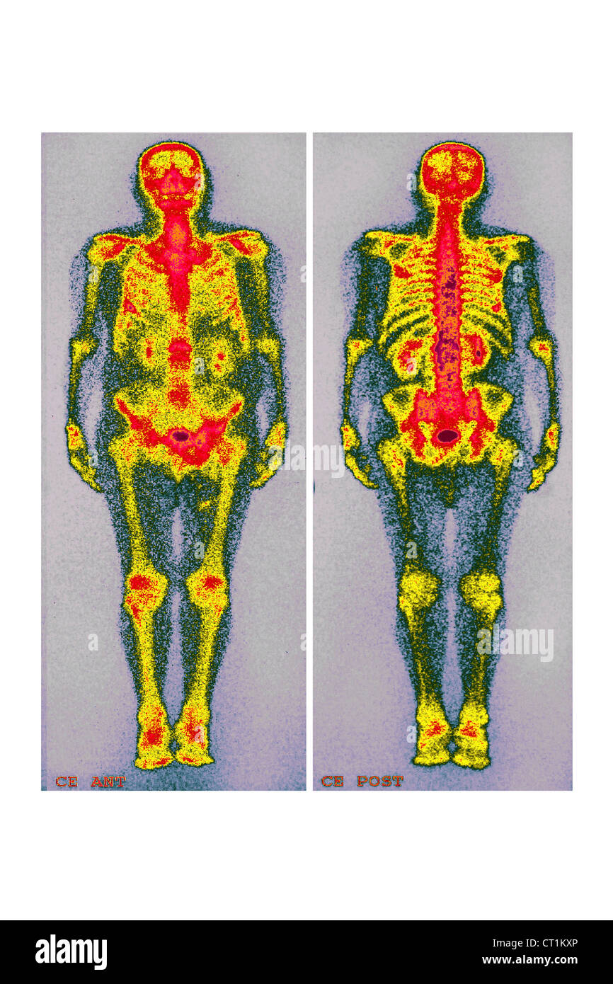 Obese body scan hi-res stock photography and images - Alamy