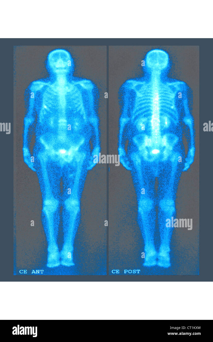 Scintigraphy hi-res stock photography and images - Alamy