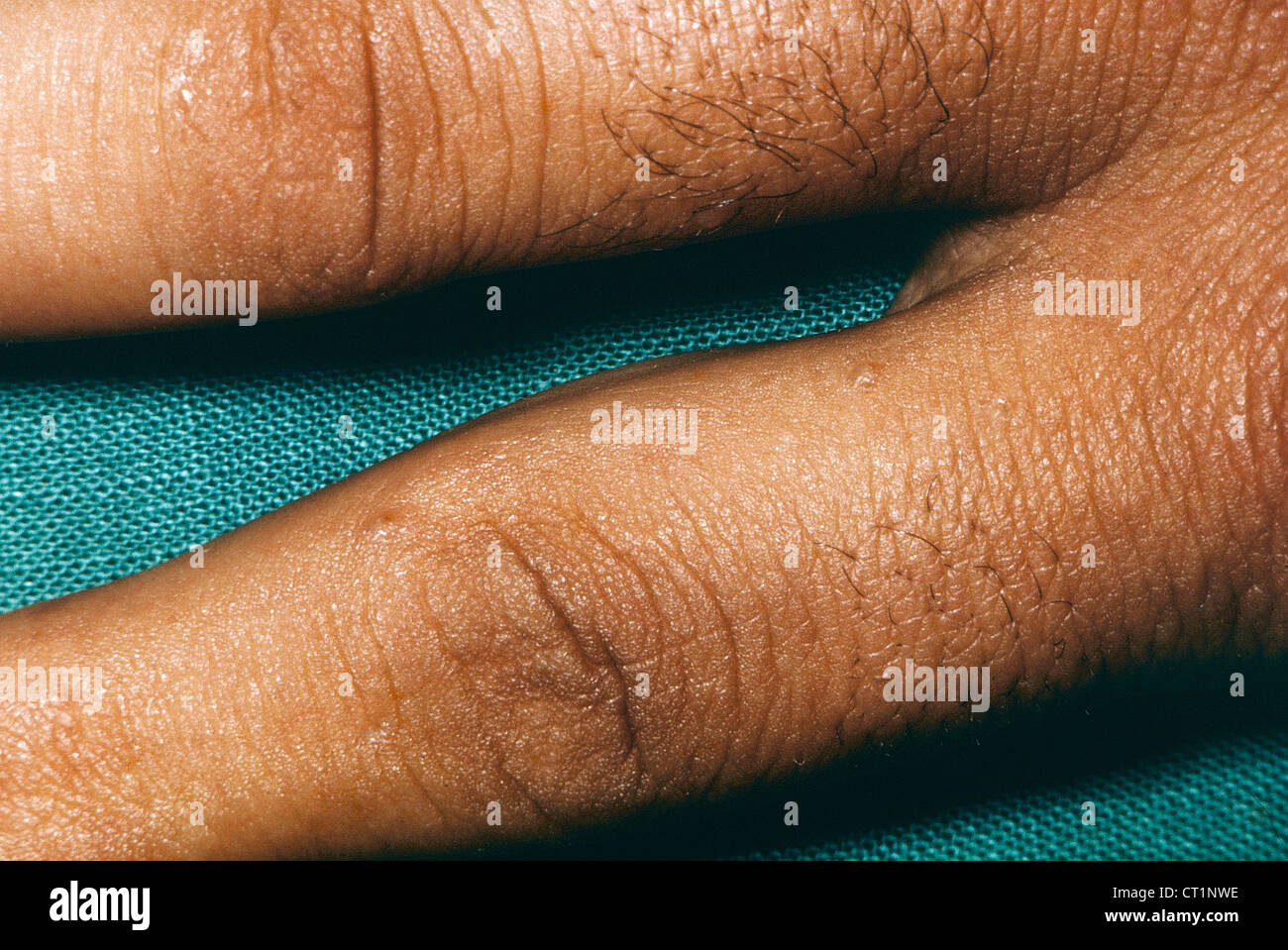 Scabies human skin hi-res stock photography and images - Alamy