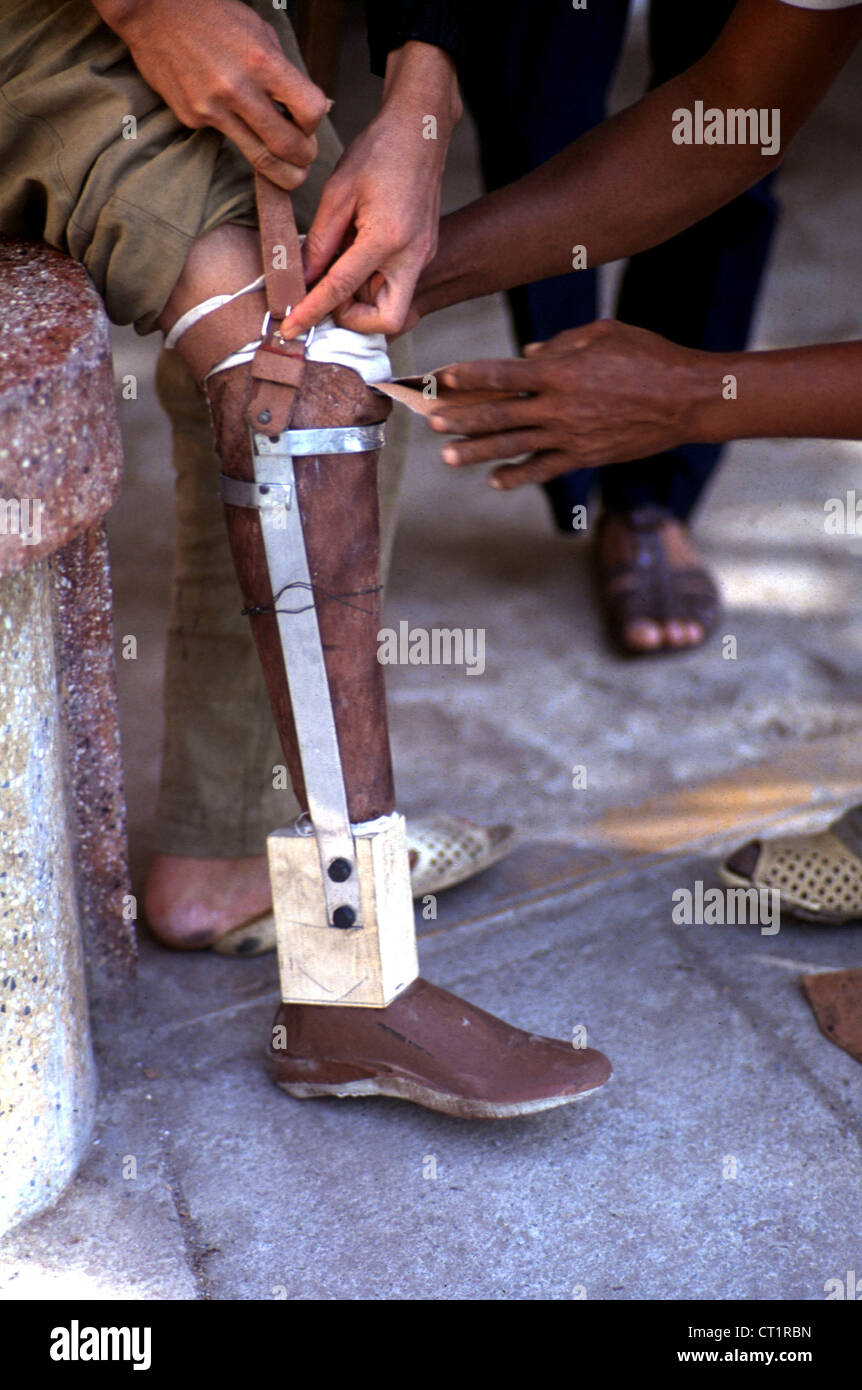 Leg amputations hi-res stock photography and images - Alamy