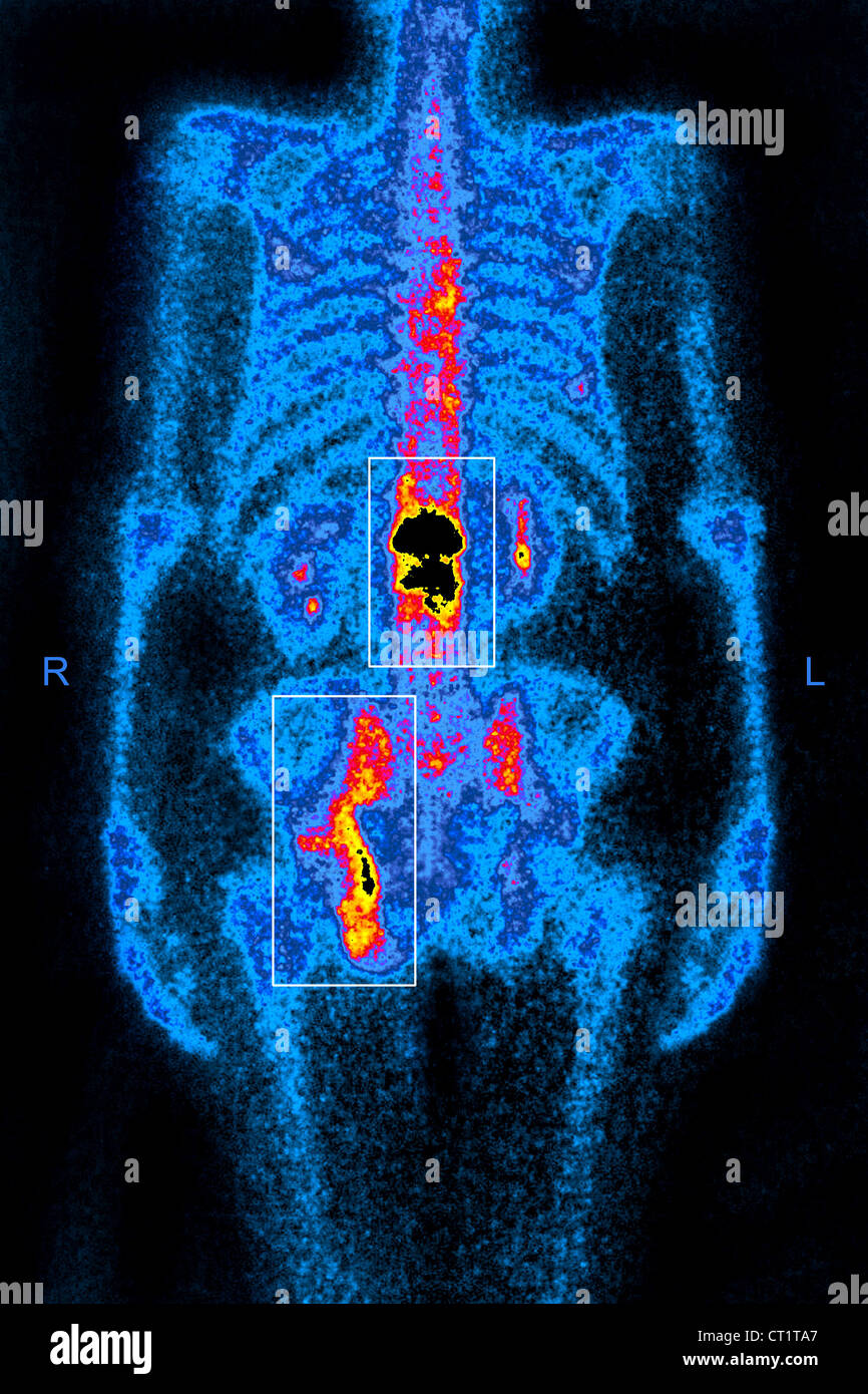 Scintigraphy Stock Photos & Scintigraphy Stock Images - Alamy