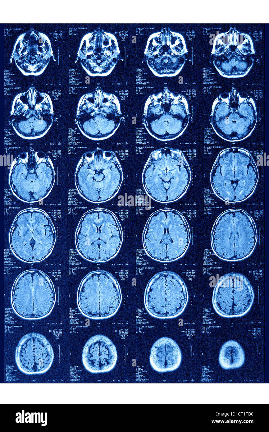 BRAIN, MRI Stock Photo - Alamy