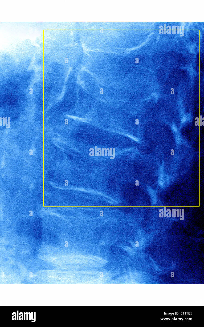 COMPRESSION FRACTURE, X-RAY Stock Photo - Alamy