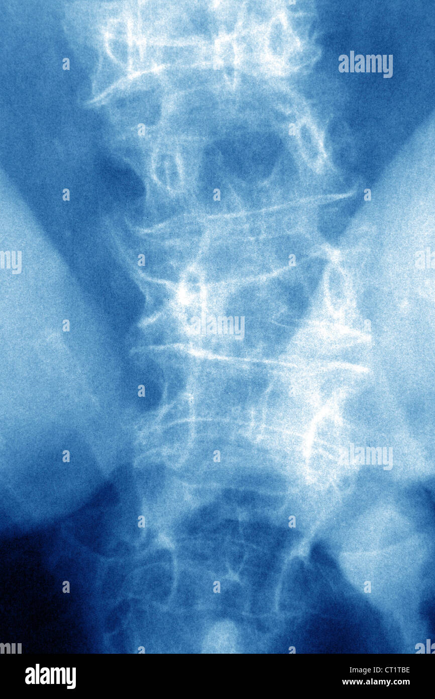 Compression vertebrae osteoporosis hi-res stock photography and images ...