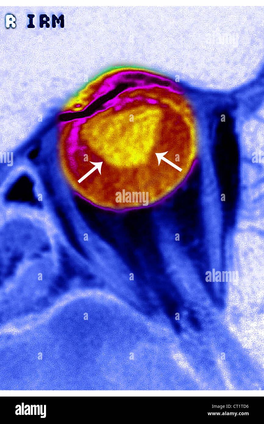 Retinal detachments hi-res stock photography and images - Alamy