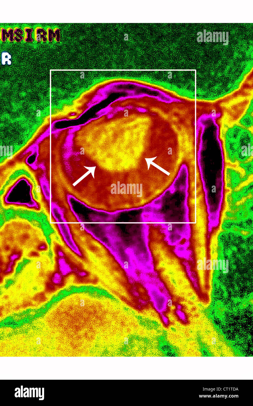 Retina detachments hi-res stock photography and images - Alamy