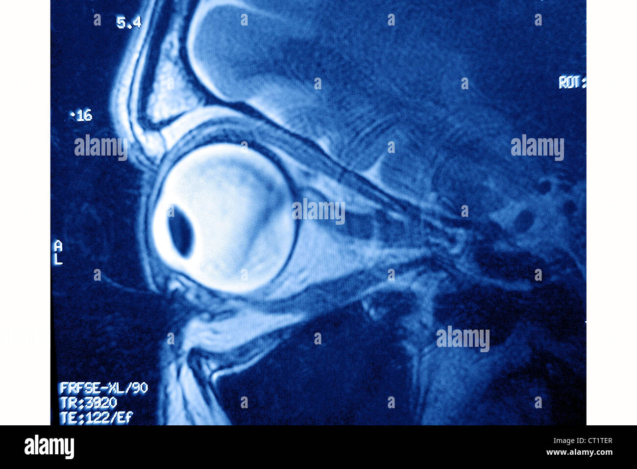 Retina detachments hi-res stock photography and images - Alamy