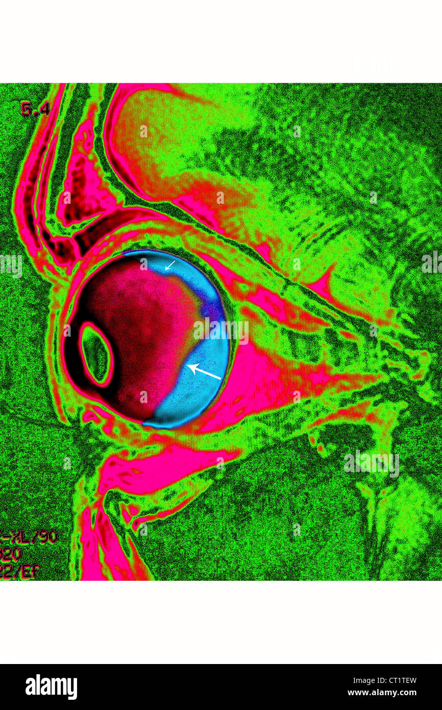 Retina detachments hi-res stock photography and images - Alamy