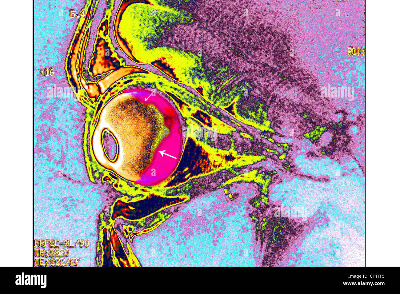 Retina detachments hi-res stock photography and images - Alamy