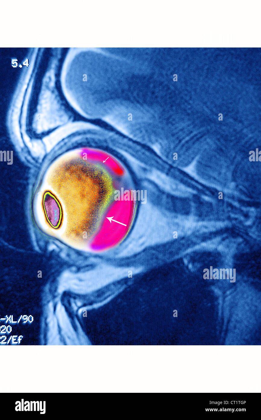 Retina detachments hi-res stock photography and images - Alamy