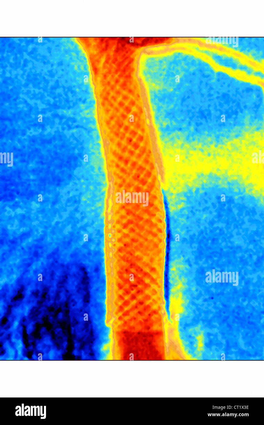 ARTERIAL ANGIOPLASTY, RESULT Stock Photo - Alamy ARTERIAL ANGIOPLASTY, RESULT Stock Photo - Alamy