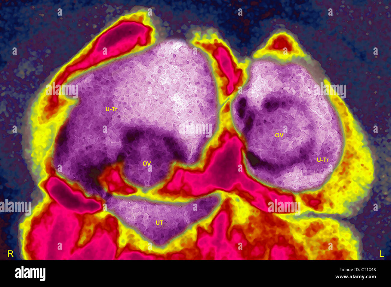 Fallopian tube salpingitis hi-res stock photography and images - Alamy