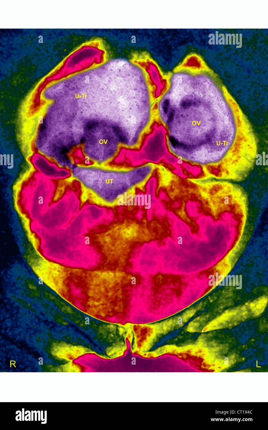 Fallopian tube salpingitis hi-res stock photography and images - Alamy