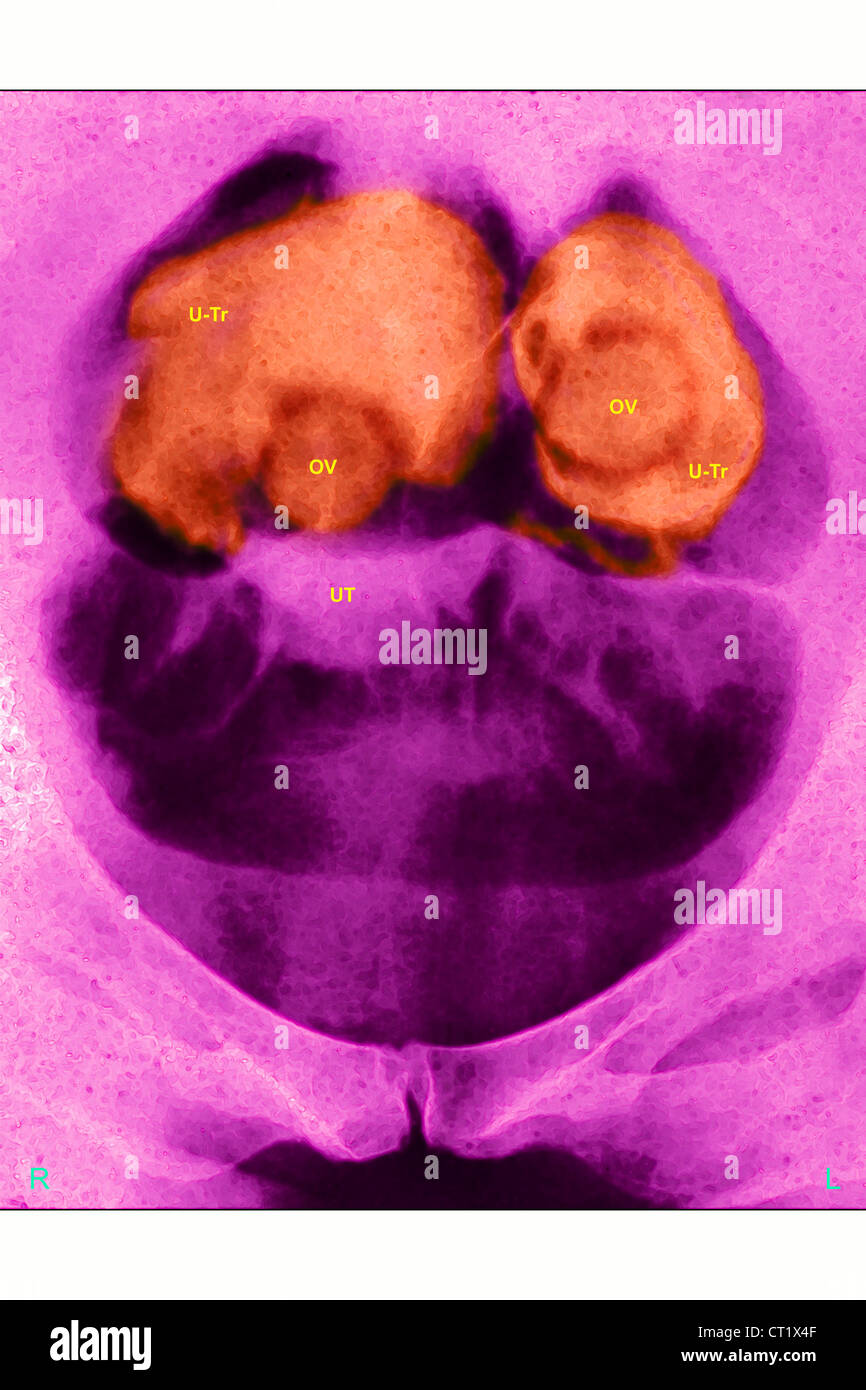 Fallopian tube salpingitis hi-res stock photography and images - Alamy