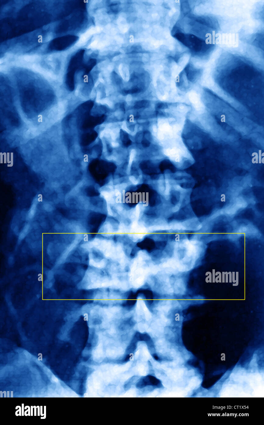 Fractured lumbar vertebra hi-res stock photography and images - Alamy