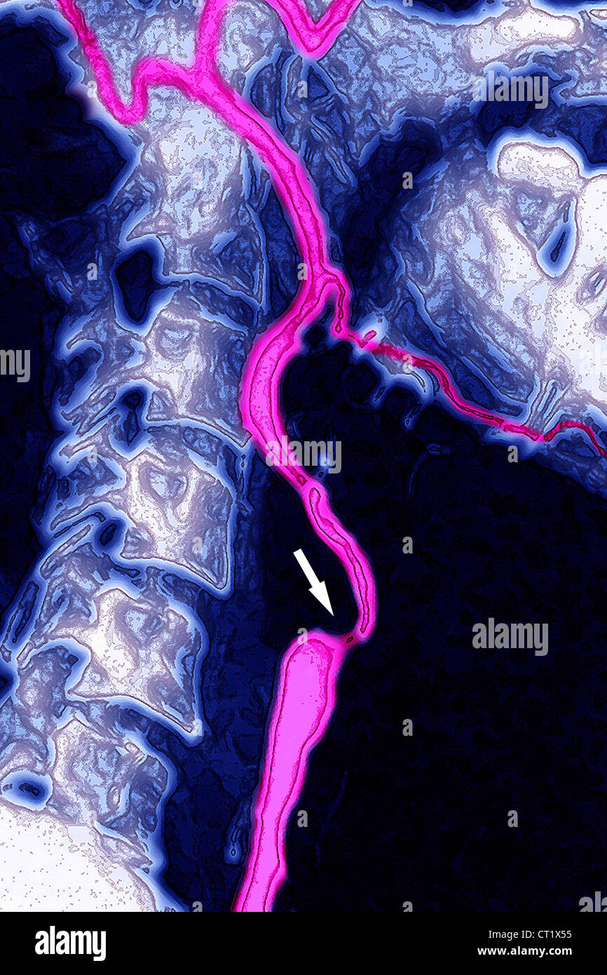 THROMBOSIS OF THE CAROTID, ANG Stock Photo - Alamy
