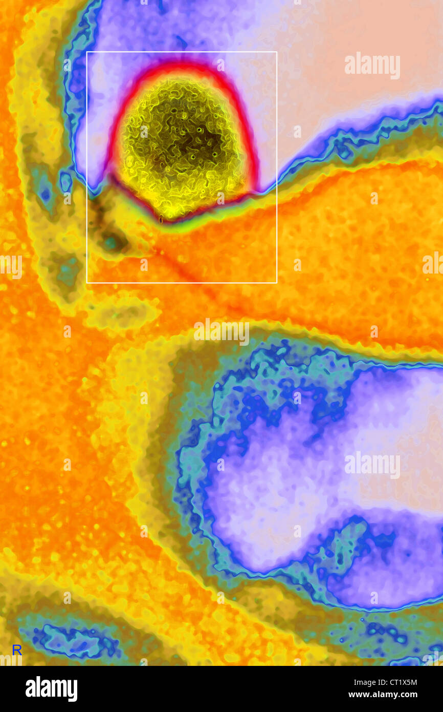 Uterine hypertrophy hi-res stock photography and images - Alamy