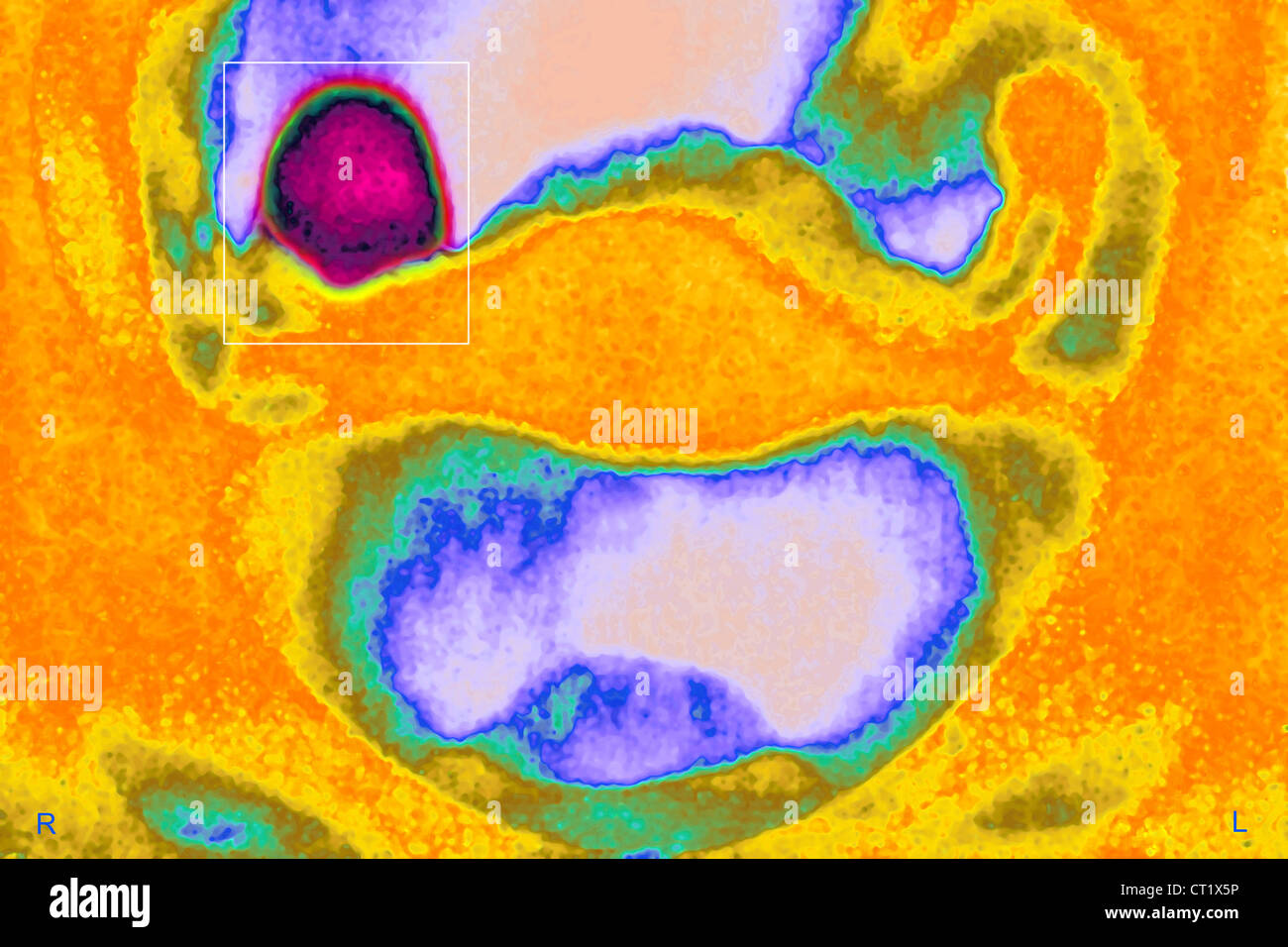 Uterine hypertrophy hi-res stock photography and images - Alamy