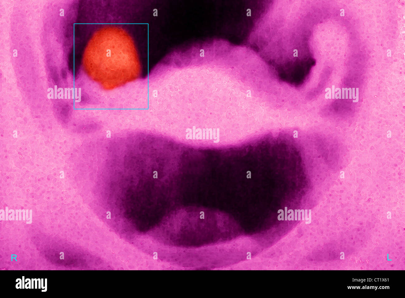 OVARY HYPERTROPHY, X-RAY Stock Photo - Alamy