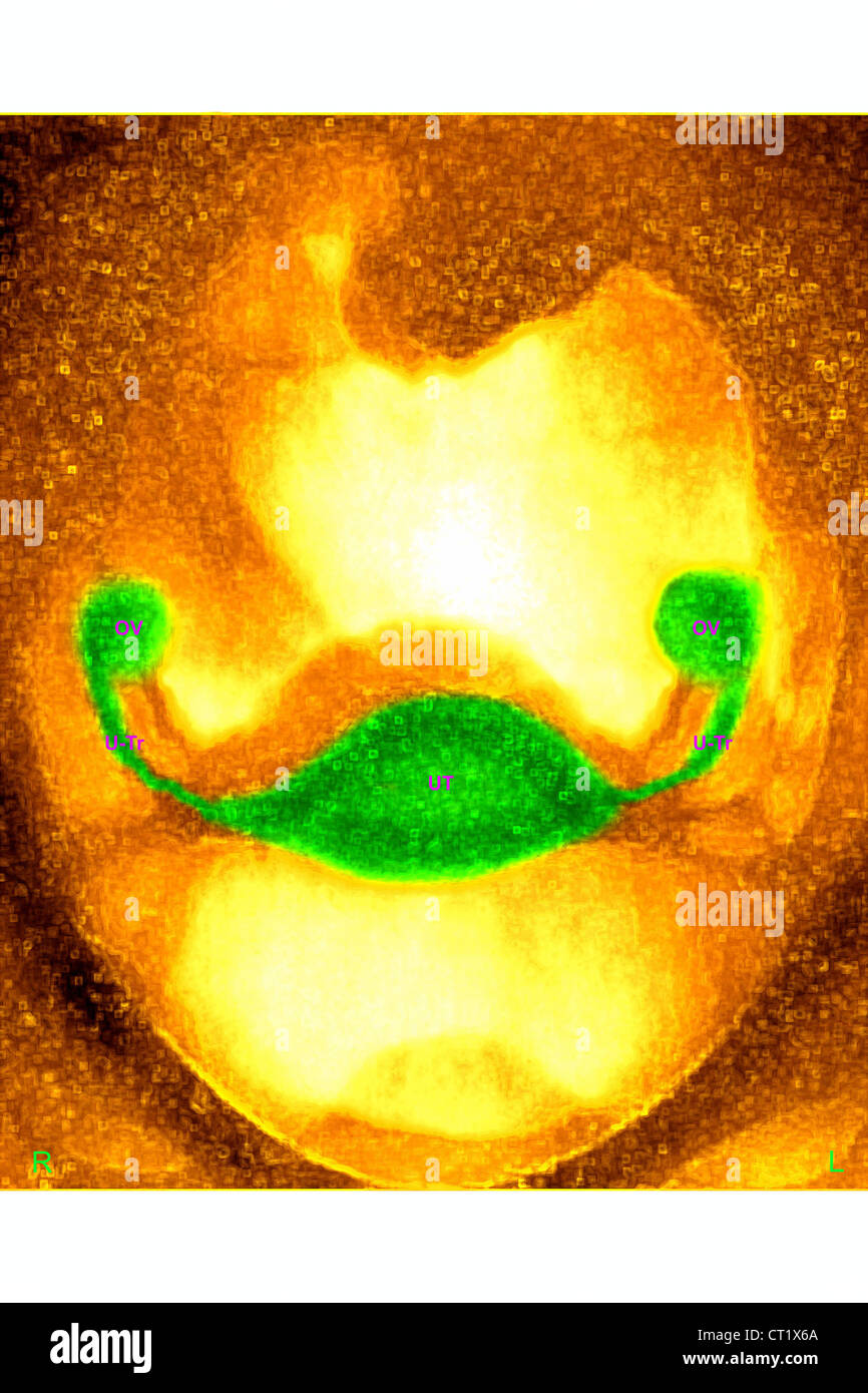 Hysterography hi-res stock photography and images - Alamy