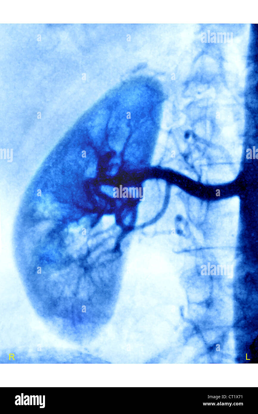Kidney artery imaging hi-res stock photography and images - Alamy