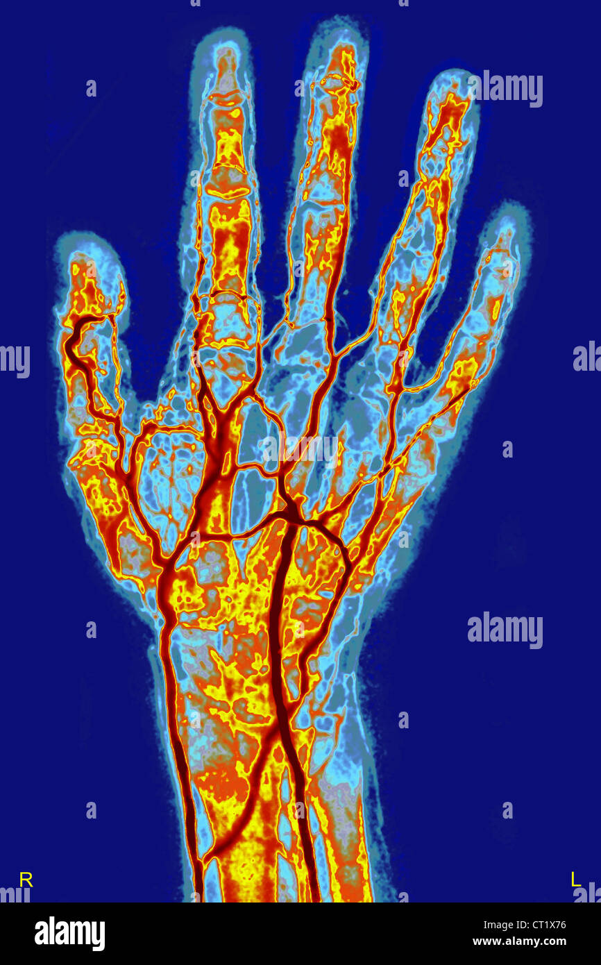 Blood vessels of the hand hi-res stock photography and images - Alamy