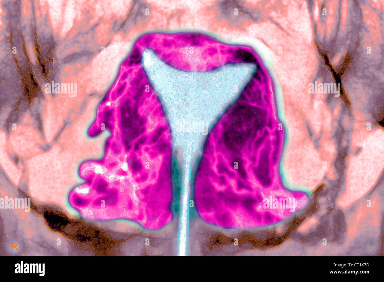 Hysterography hi-res stock photography and images - Alamy