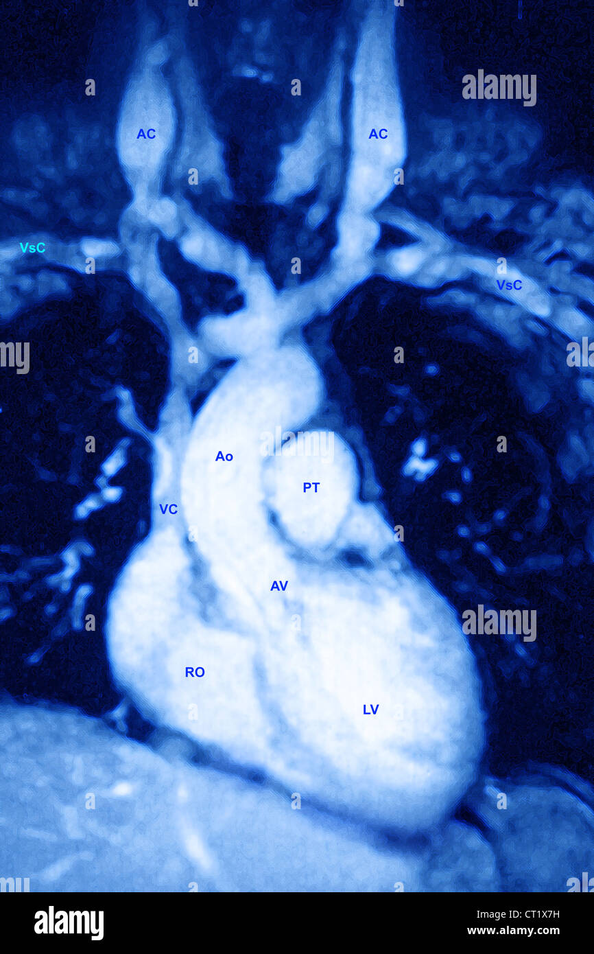 Mri Of The Blood Vessels Stock Photos & Mri Of The Blood Vessels Stock ...