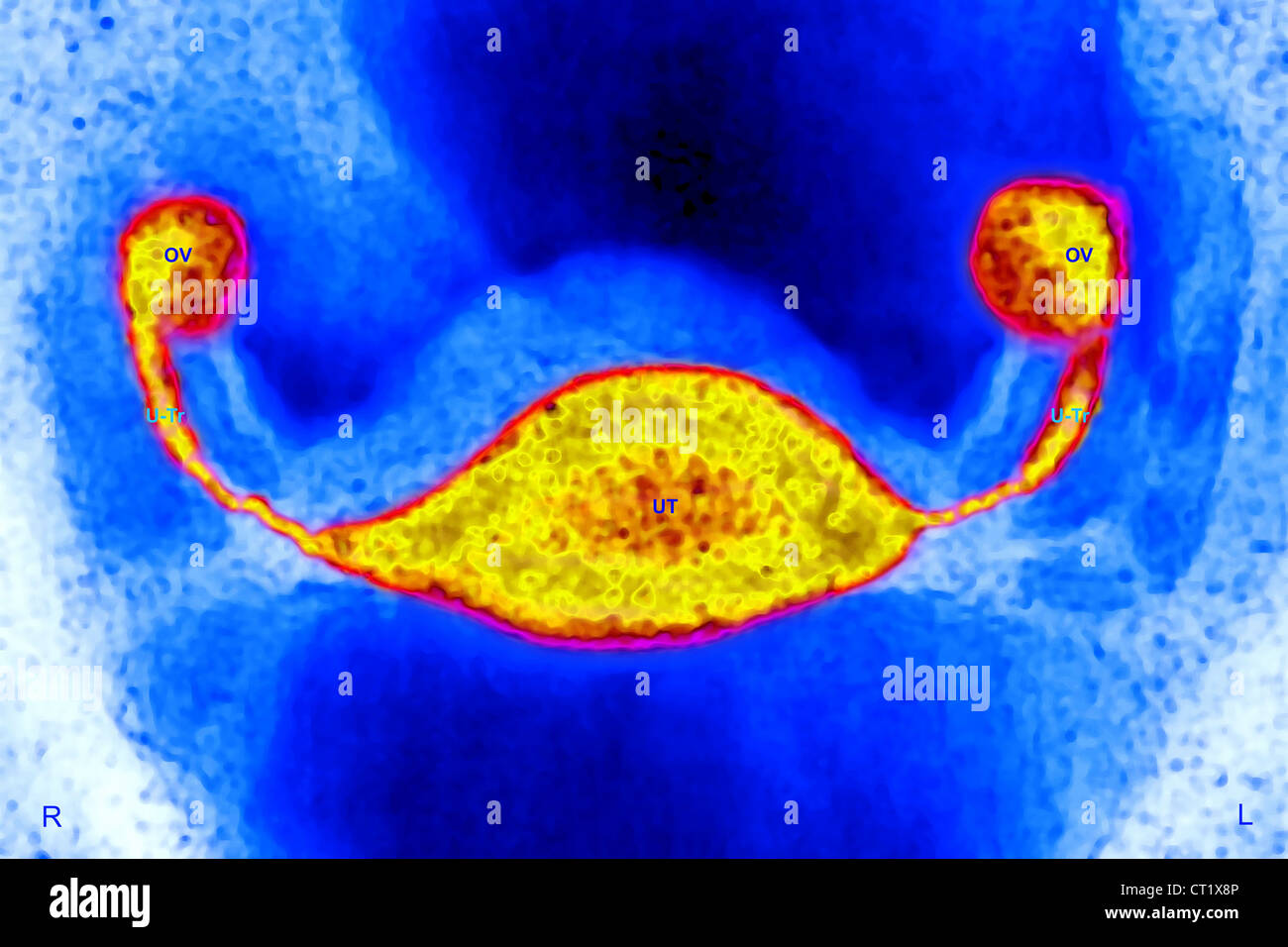 Hysterography High Resolution Stock Photography and Images - Alamy