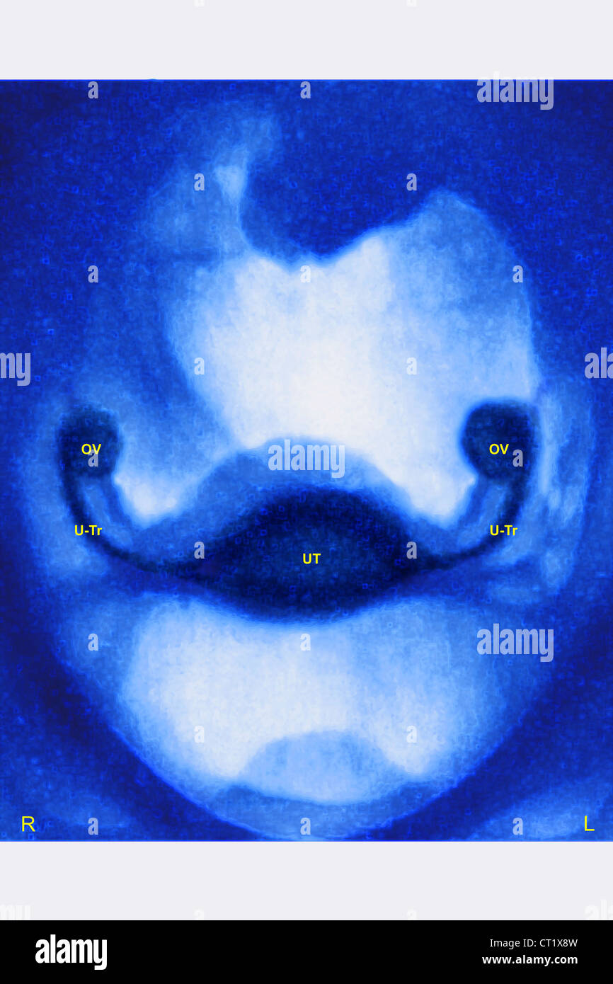 Hysterography High Resolution Stock Photography and Images - Alamy