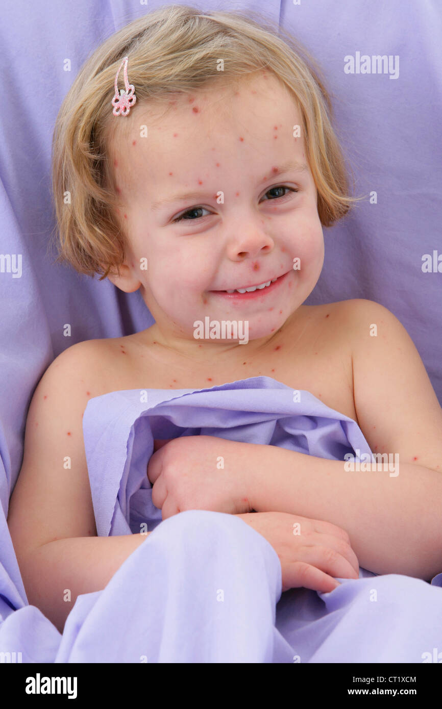 Year Old Child Chickenpox High Resolution Stock Photography and Images ...