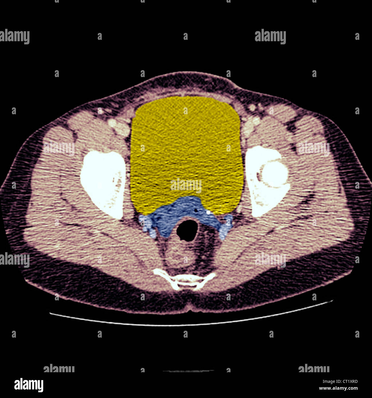 Bladder scan hi-res stock photography and images - Alamy