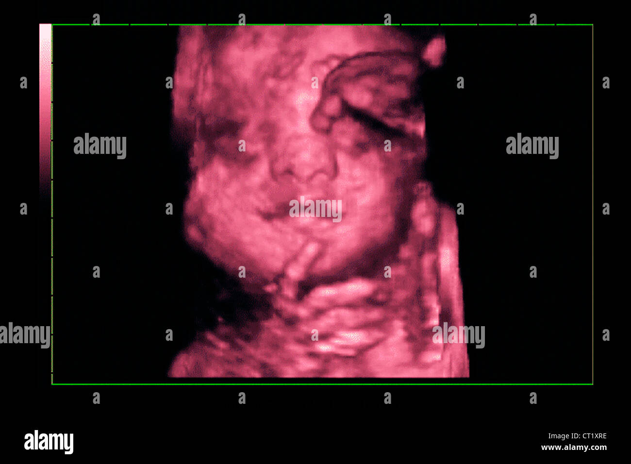 Fetus 6 weeks hi-res stock photography and images - Alamy