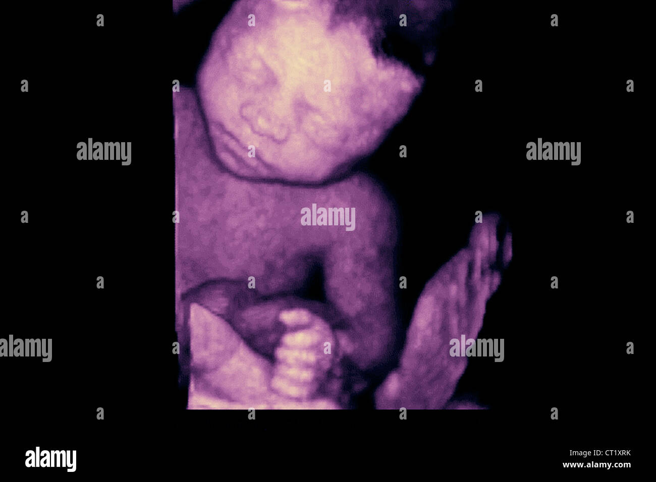 FETUS, 3D SONOGRAPHY Stock Photo - Alamy