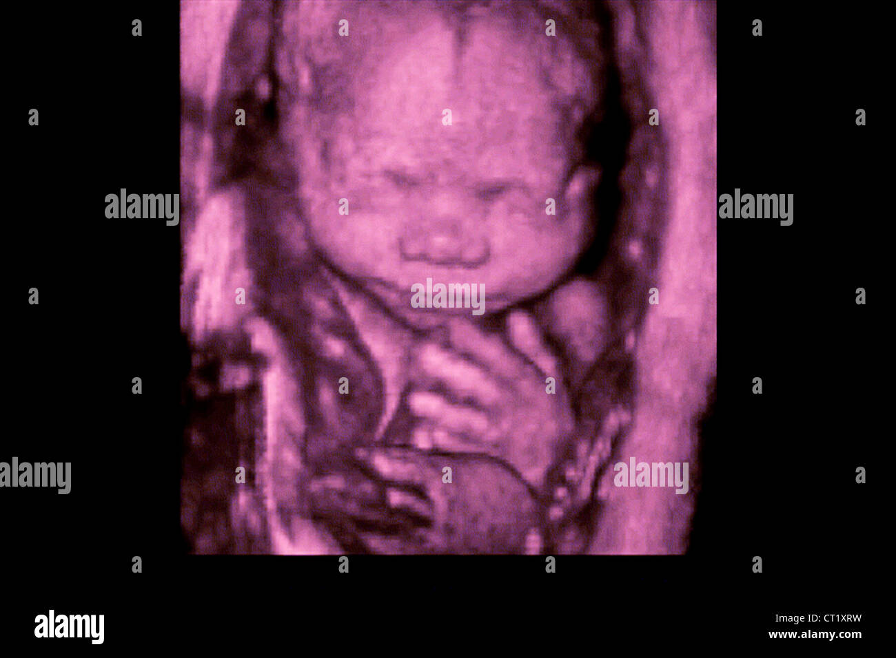 24 week old fetus hi-res stock photography and images - Alamy