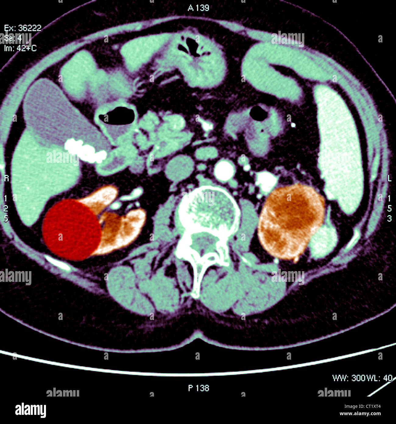 Ct Scan Kidney Cancer at Laura Hefley blog