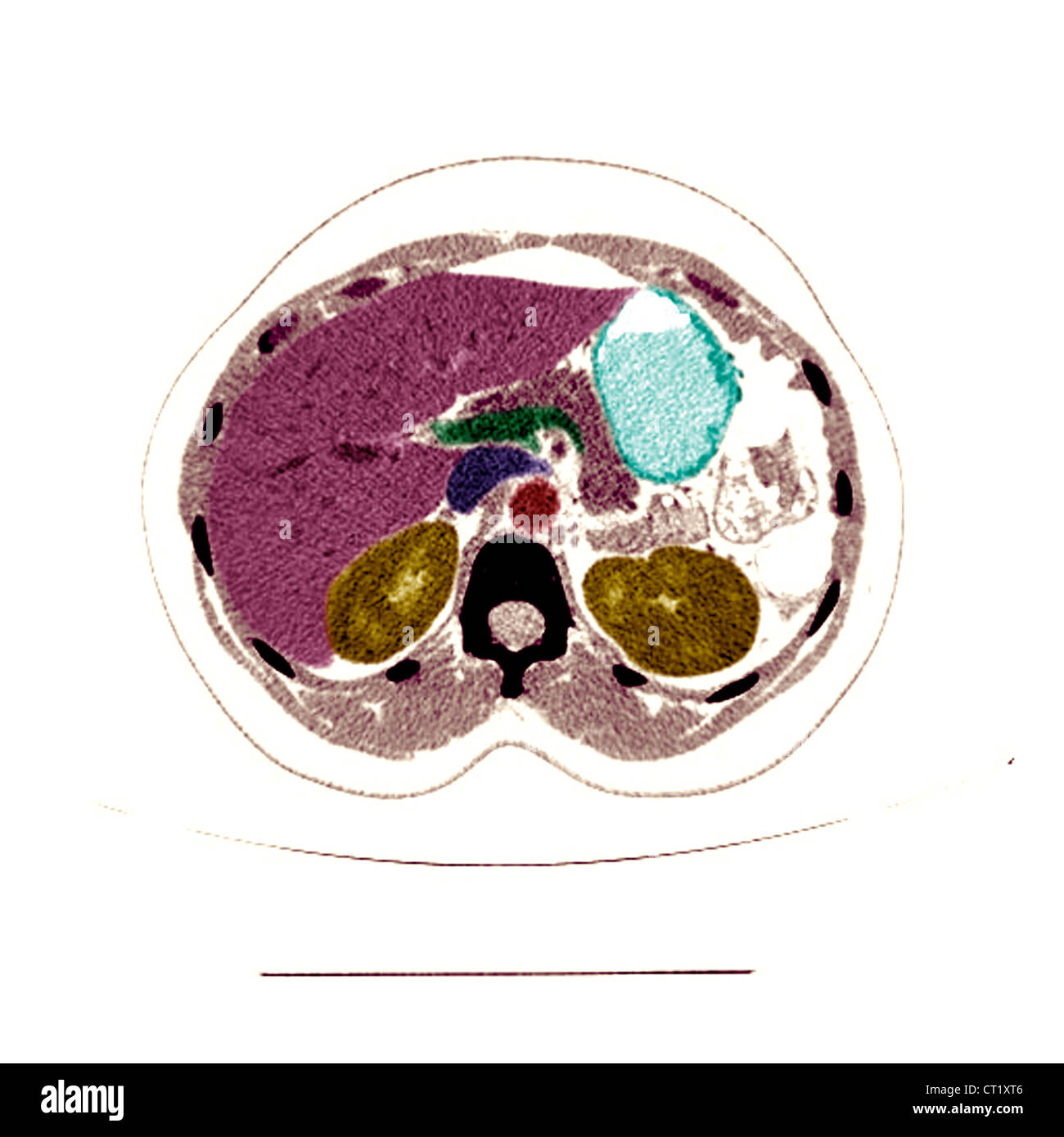 Vena splenica hi-res stock photography and images - Alamy