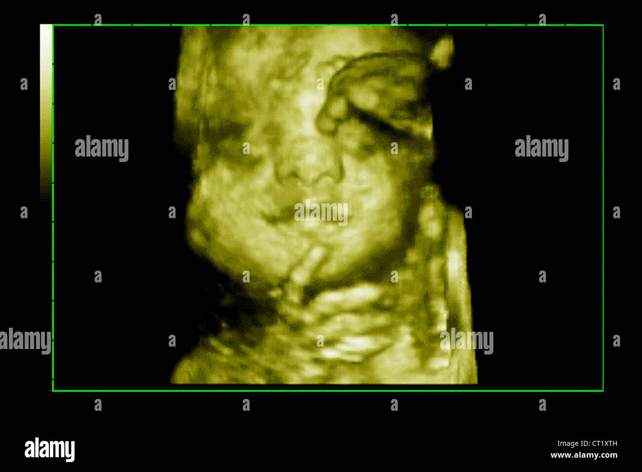 FETUS, 3D SONOGRAPHY Stock Photo - Alamy