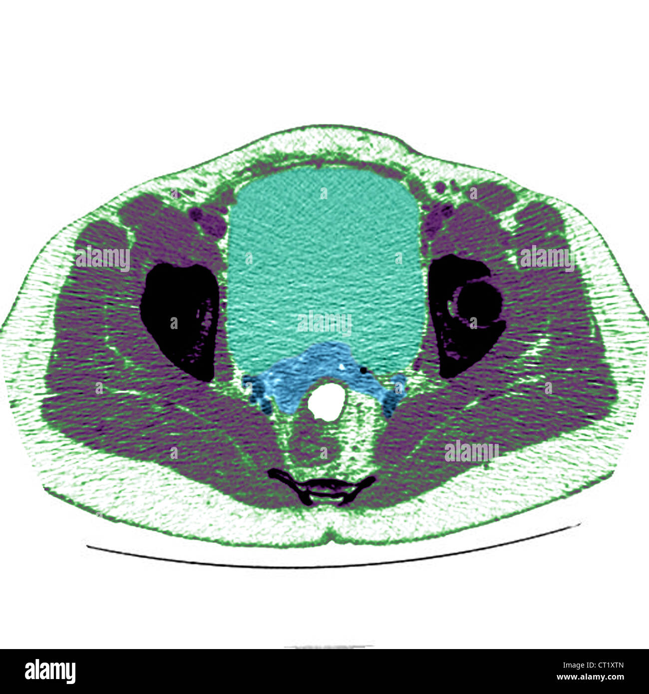 Healthy bladder scan hi-res stock photography and images - Alamy